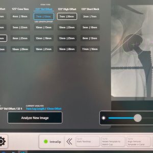 Direct Anterior Approach Hip Replacement
